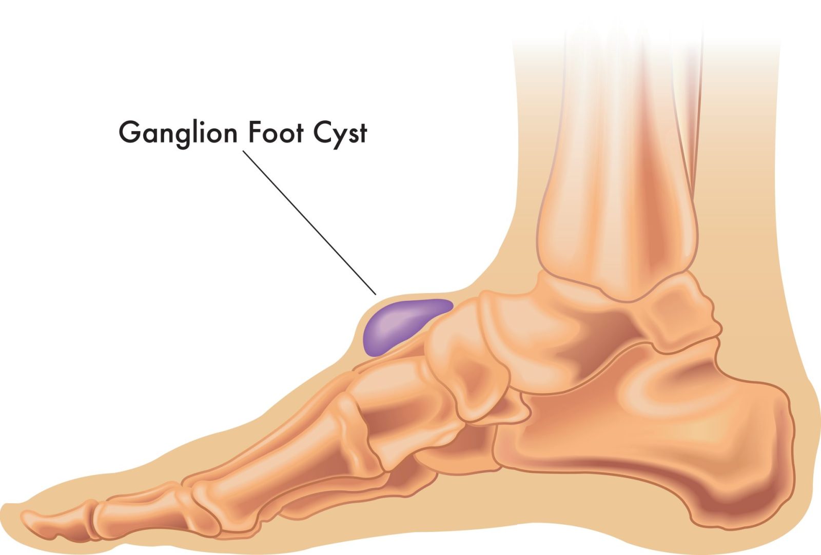 Ganglion Cysts – All You Need to Know